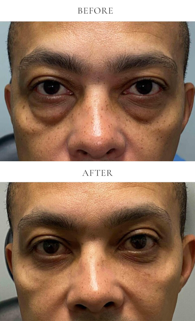 Lower Eyelid Blepharoplasty - VEI Aesthetics
